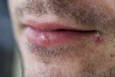 ¿Cuál Es la Diferencia Entre un ampollas de Fiebre & un herpes labial?