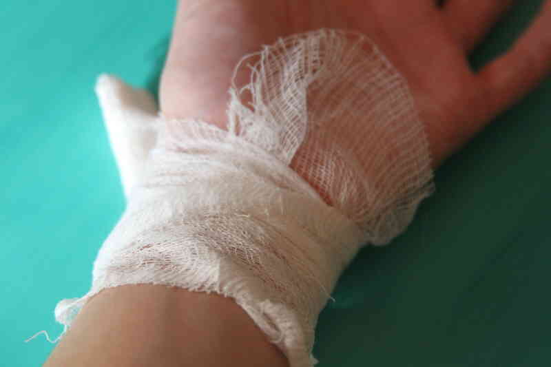 Cómo Lidiar Con un Hueso Roto de Emergencia