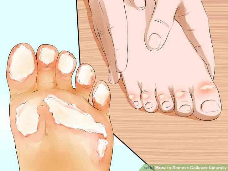Cómo Quitar los Callos de forma Natural