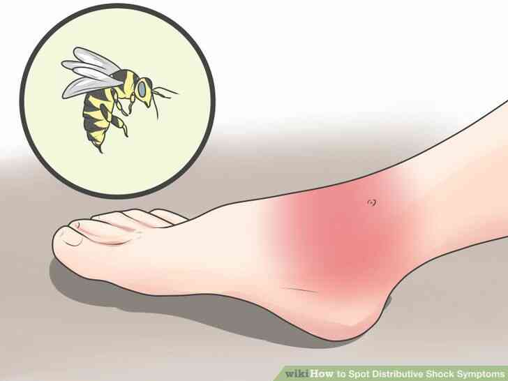 Cómo detectar los Síntomas de Shock Distributivo